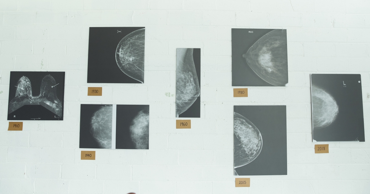 What to Know About Mammography Guidelines | Clinical Perspectives