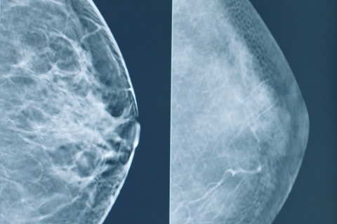Solis Mammography | Solis Mammography
